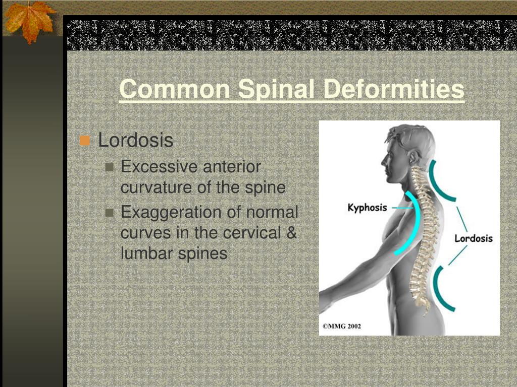 PPT - Common Spinal Deformities PowerPoint Presentation, free download ...