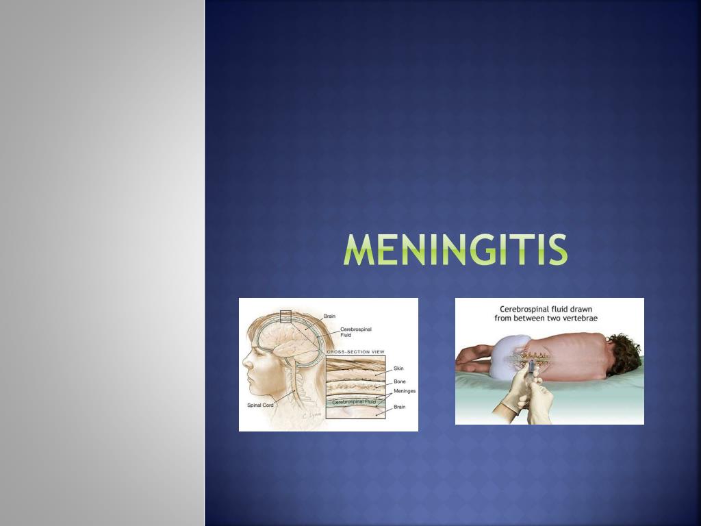 PPT - meningitis PowerPoint Presentation, free download - ID:1848451