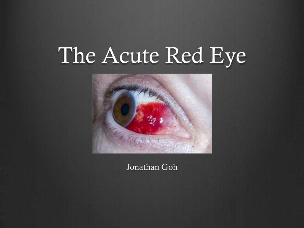 PPT - The Acute Red Eye PowerPoint Presentation, free download - ID:1867043
