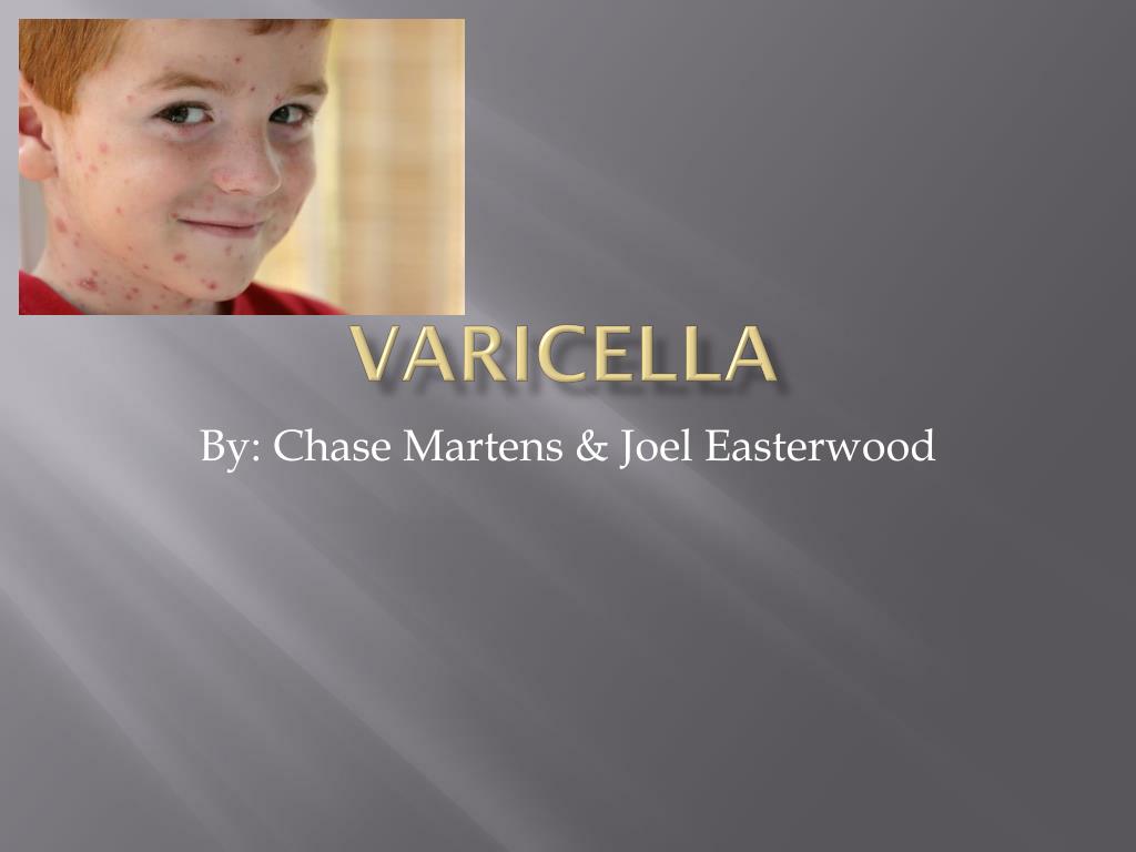 PPT - Varicella PowerPoint Presentation, free download - ID:1885246