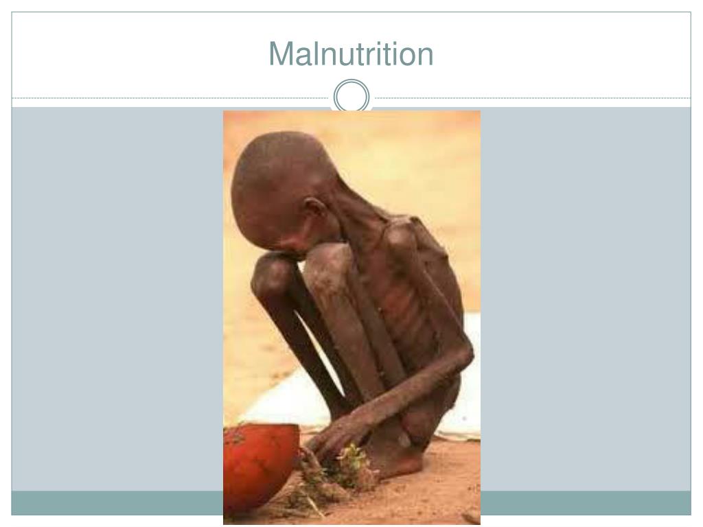 PPT - Malnutrition PowerPoint Presentation, free download - ID:1938063