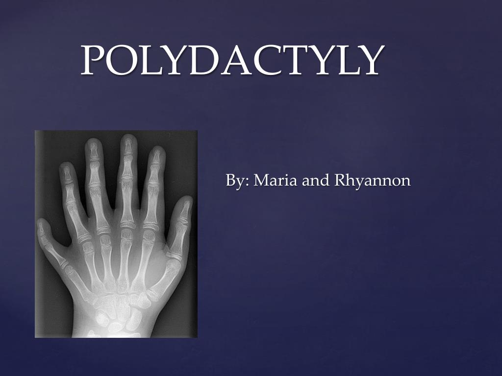 PPT - POLYDACTYLY PowerPoint Presentation, free download - ID:1961361
