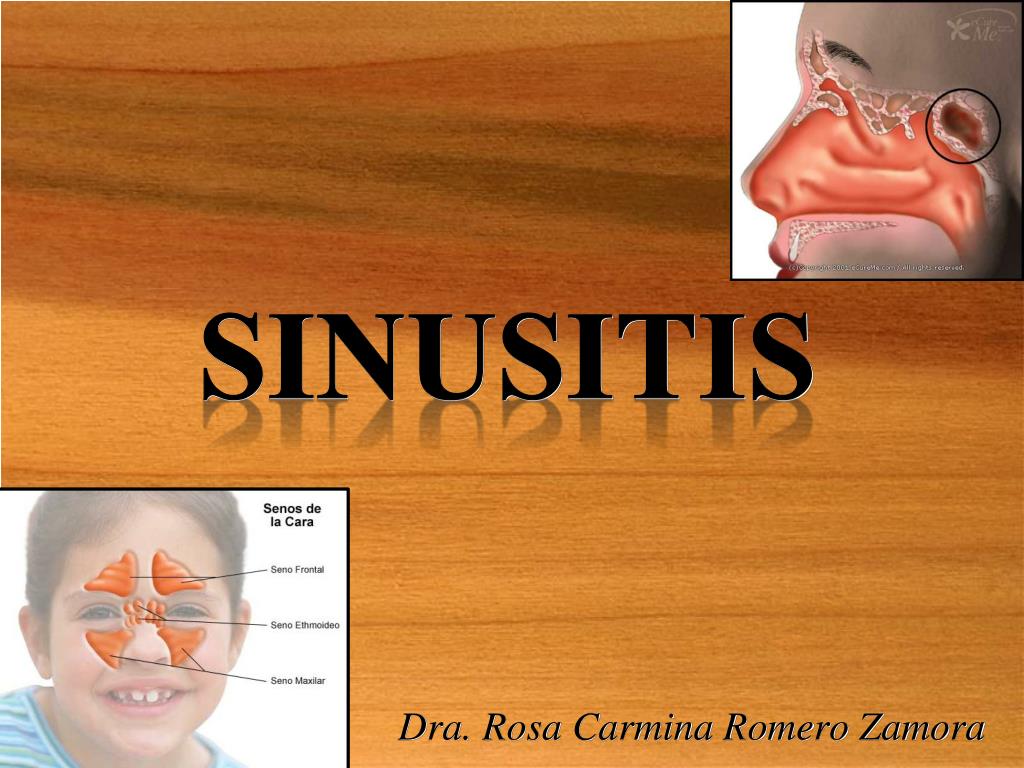 PPT - Sinusitis PowerPoint Presentation, free download - ID:1972590