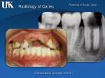 PPT - MANAGEMENT OF DEEP CARIES LESIONS PowerPoint Presentation, free ...
