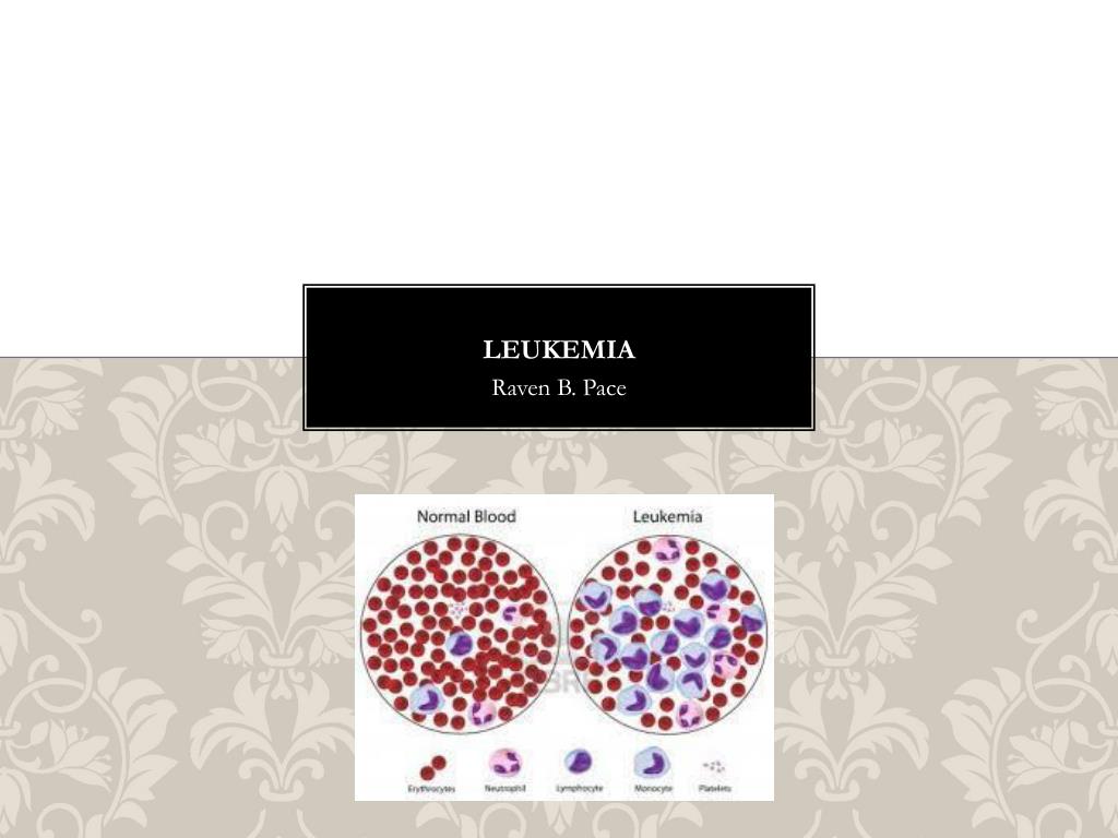 PPT - Leukemia PowerPoint Presentation, free download - ID:2030790