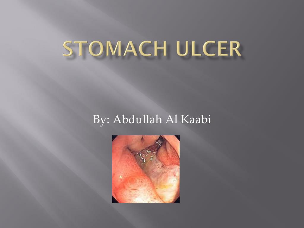 PPT - Stomach ulcer PowerPoint Presentation, free download - ID:2034291
