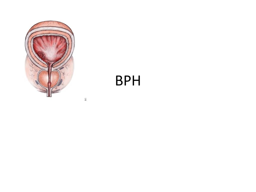 PPT - BPH PowerPoint Presentation, free download - ID:2046813