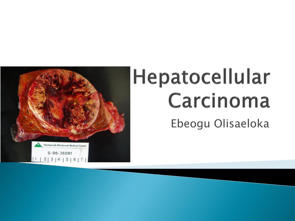PPT - Hepatocellular Carcinoma PowerPoint Presentation, free download ...