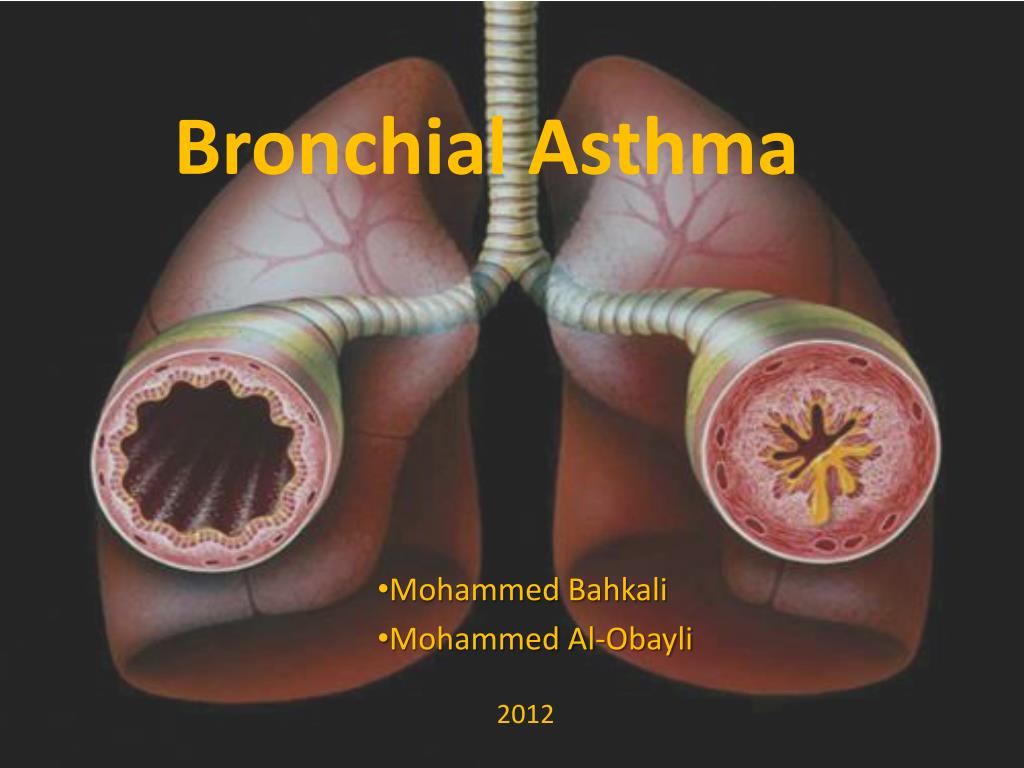 PPT - Bronchial Asthma PowerPoint Presentation, free download - ID:2097237