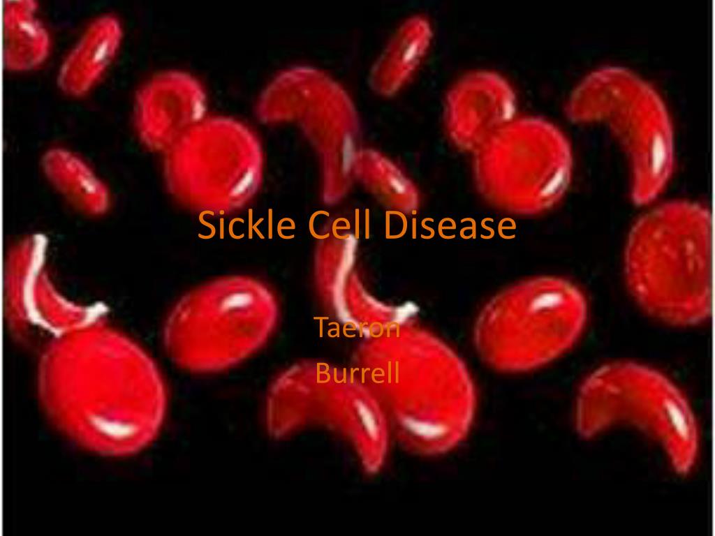 PPT - Sickle Cell Disease PowerPoint Presentation, free download - ID ...