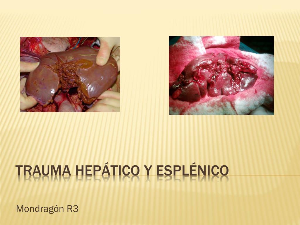 PPT - TRAUMA HEPÁTICO Y ESPLÉNICO PowerPoint Presentation, free ...
