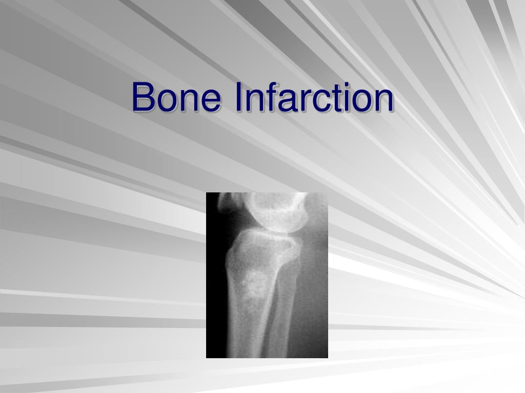 PPT - Bone Infarction PowerPoint Presentation, free download - ID:2134779