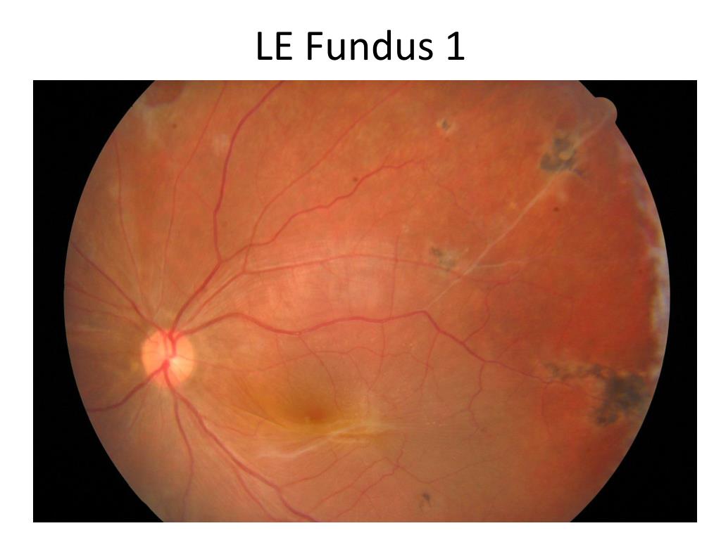 PPT - LE Fundus 1 PowerPoint Presentation, free download - ID:2155778
