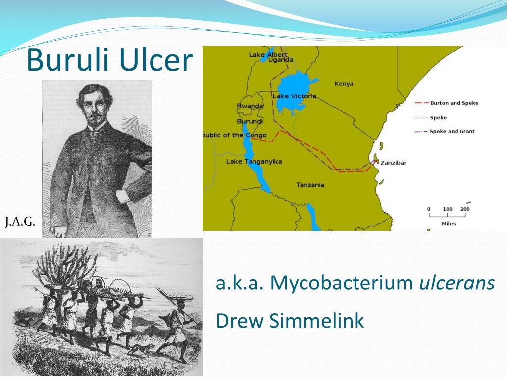 PPT - Buruli Ulcer PowerPoint Presentation, free download - ID:2188031
