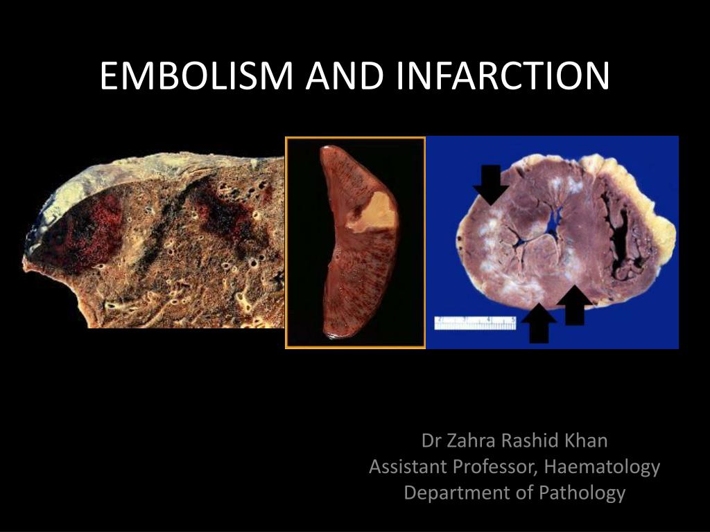 PPT - EMBOLISM AND INFARCTION PowerPoint Presentation, free download ...