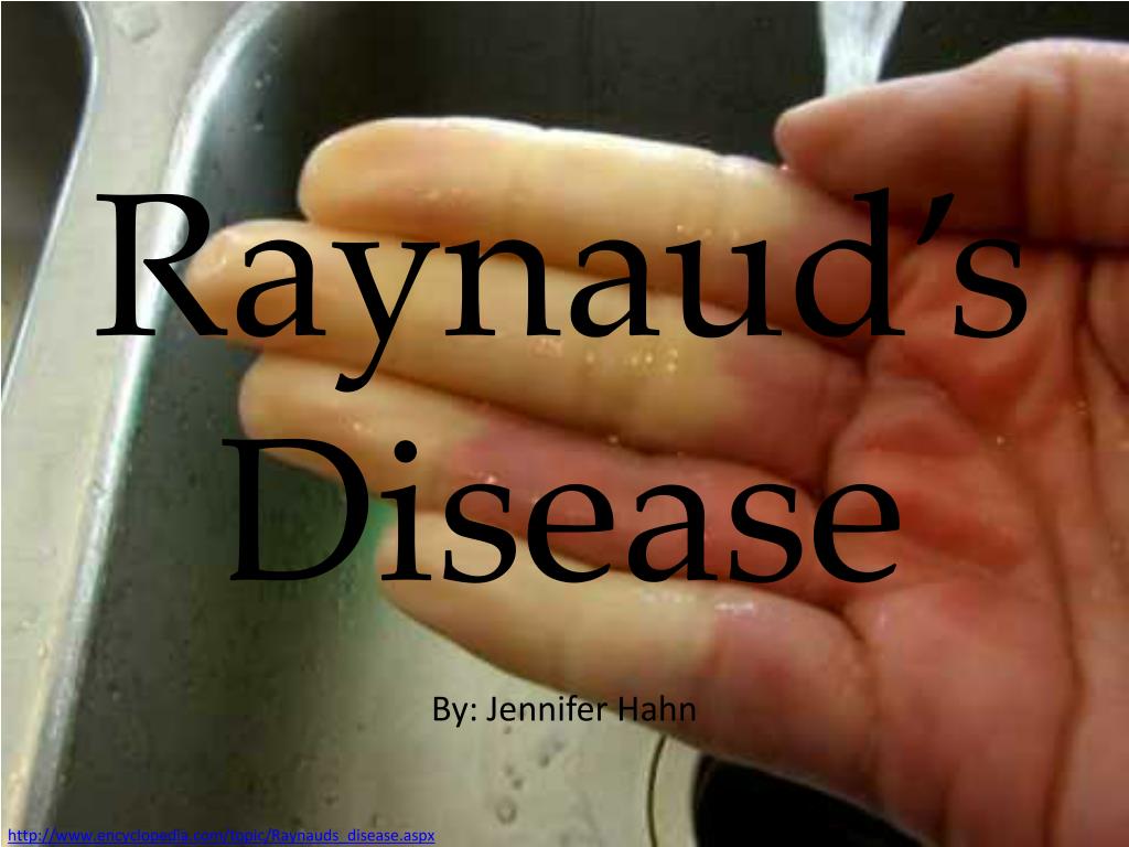 PPT - Raynaud’s Disease PowerPoint Presentation, free download - ID:2223763