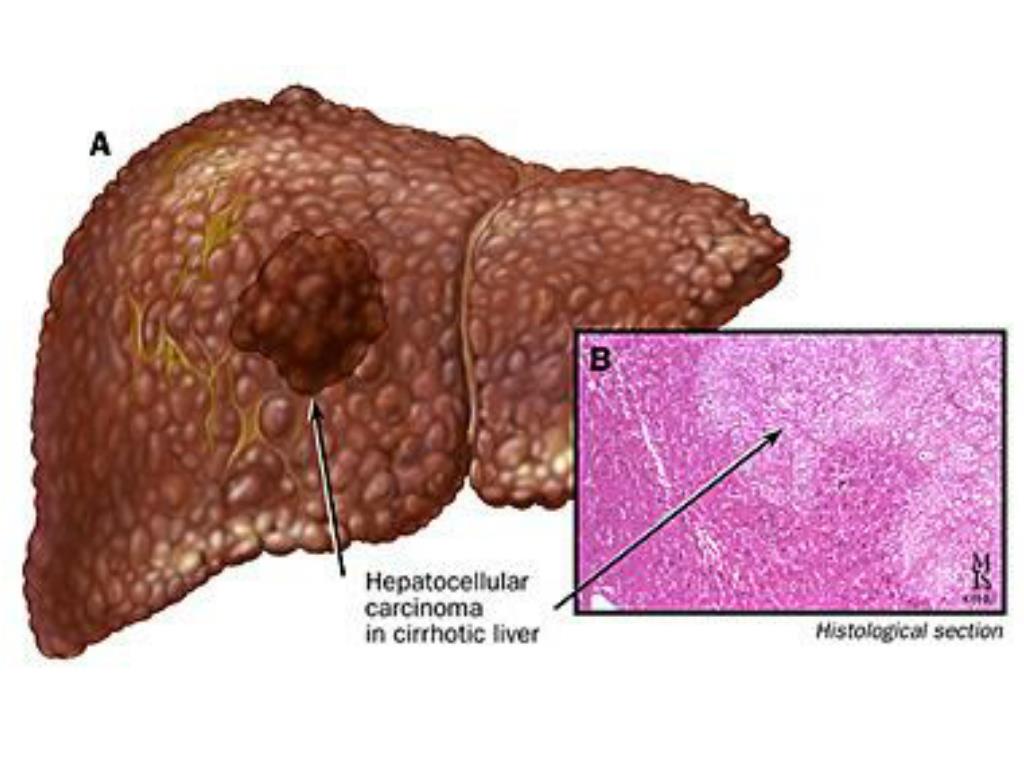 PPT - Hepatocellular carcinoma PowerPoint Presentation, free download ...