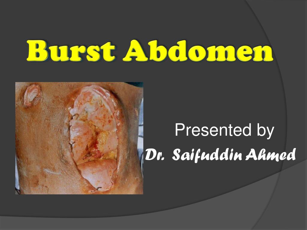 PPT - Burst Abdomen PowerPoint Presentation, free download - ID:2241334