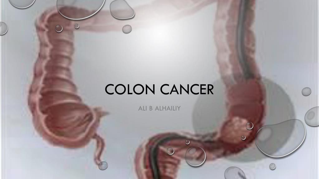 PPT - Colon cancer PowerPoint Presentation, free download - ID:2245225