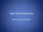 PPT - Two Year Outcomes of Southwick-Fulkerson Osteotomy PowerPoint ...