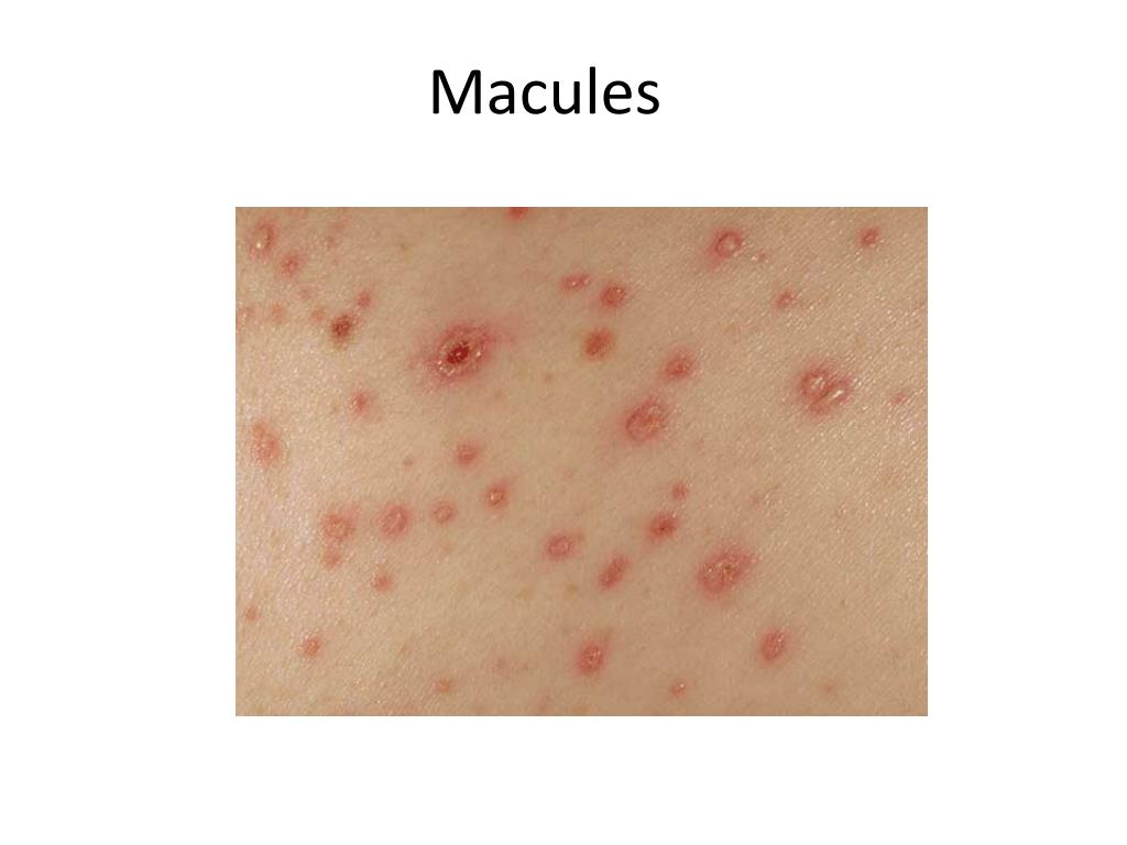 PPT - Macules PowerPoint Presentation, free download - ID:2264306