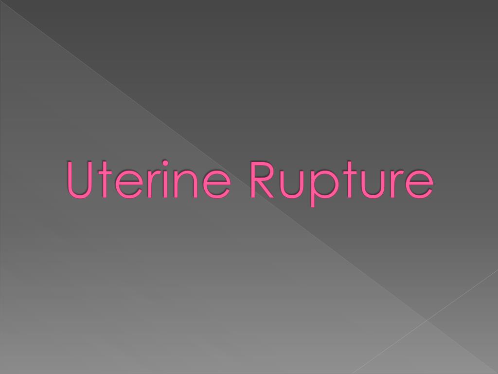 PPT - Uterine Rupture PowerPoint Presentation, free download - ID:2283868