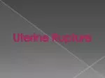 PPT - UTERINE RUPTURE PowerPoint Presentation, free download - ID:506056