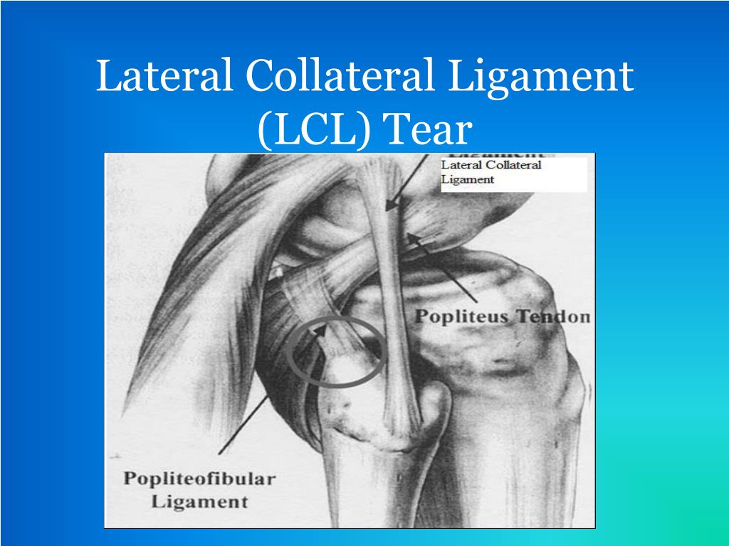 PPT - Lateral Collateral Ligament (LCL) Tear PowerPoint Presentation ...