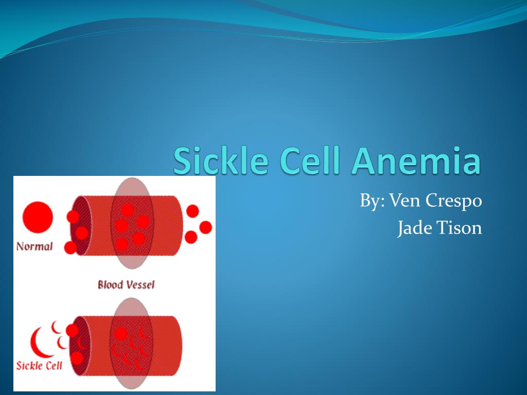 PPT - Sickle Cell Anemia PowerPoint Presentation, free download - ID ...
