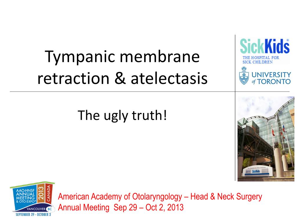 PPT - Tympanic membrane retraction & atelectasis PowerPoint ...