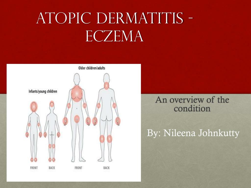 PPT - Atopic dermatitis - ECZEMA PowerPoint Presentation, free download ...