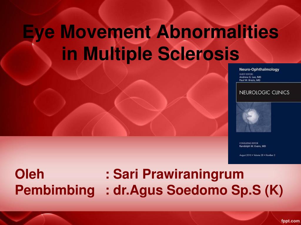 PPT - Eye Movement Abnormalities in Multiple Sclerosis PowerPoint ...