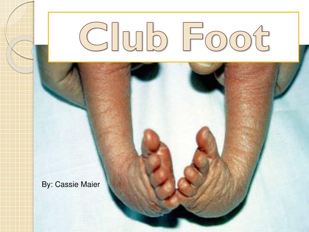 PPT - Club Foot PowerPoint Presentation, free download - ID:2402471