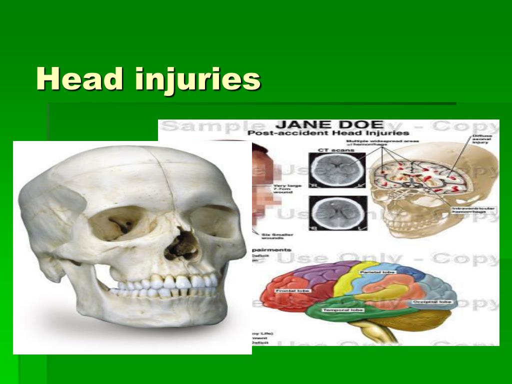 PPT - Head injuries PowerPoint Presentation, free download - ID:2409979