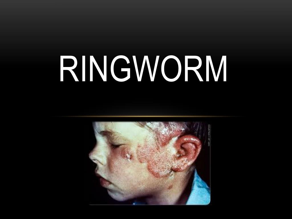 PPT - ringworm PowerPoint Presentation, free download - ID:2444808