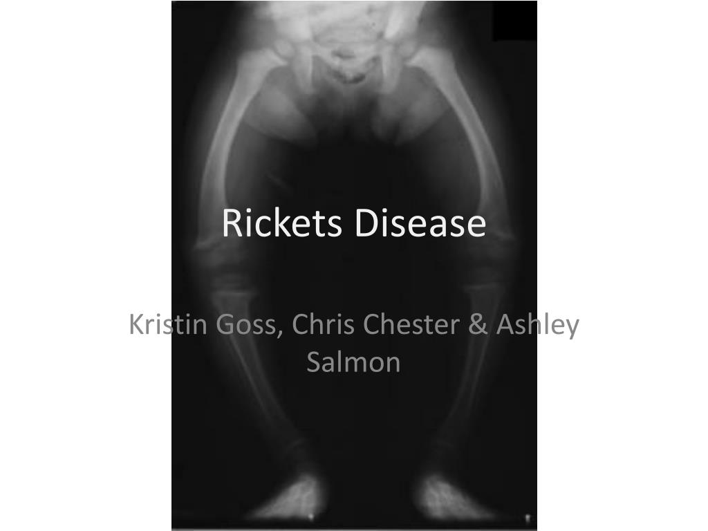 PPT - Rickets Disease PowerPoint Presentation, free download - ID:2568458