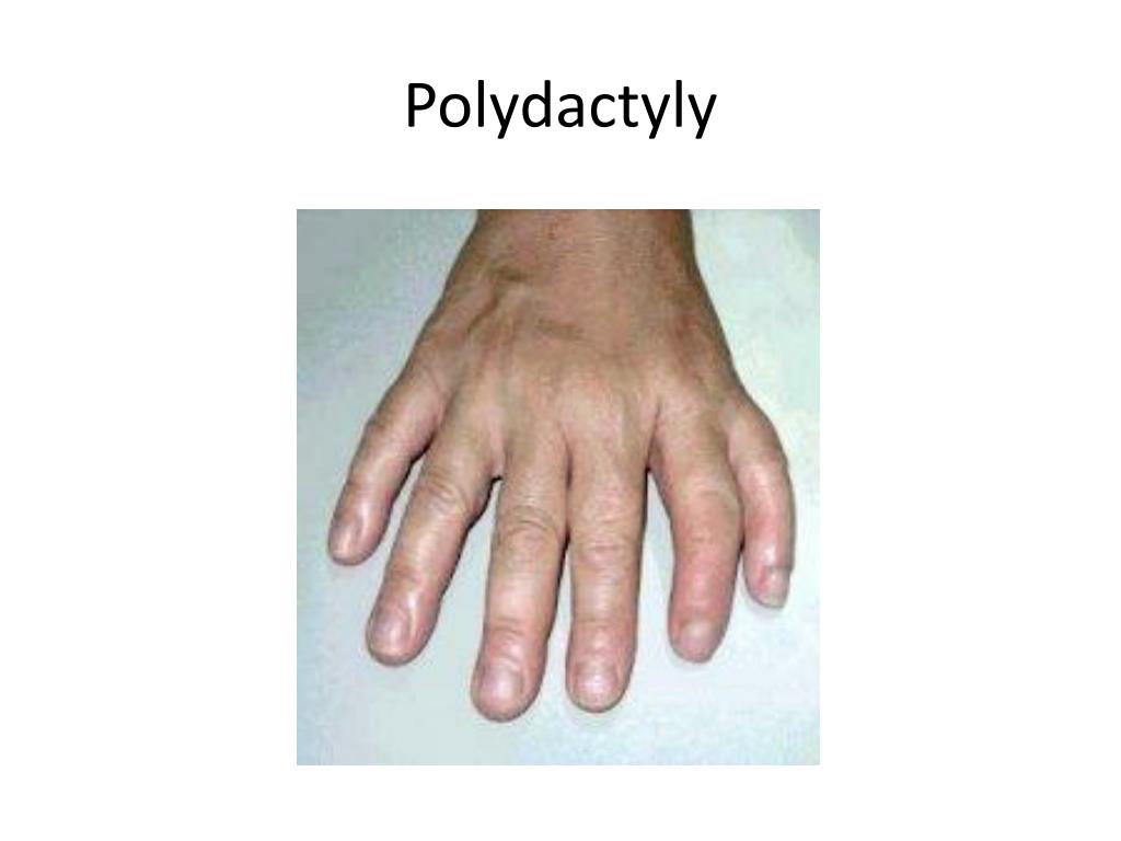 PPT - Polydactyly PowerPoint Presentation, free download - ID:2605265
