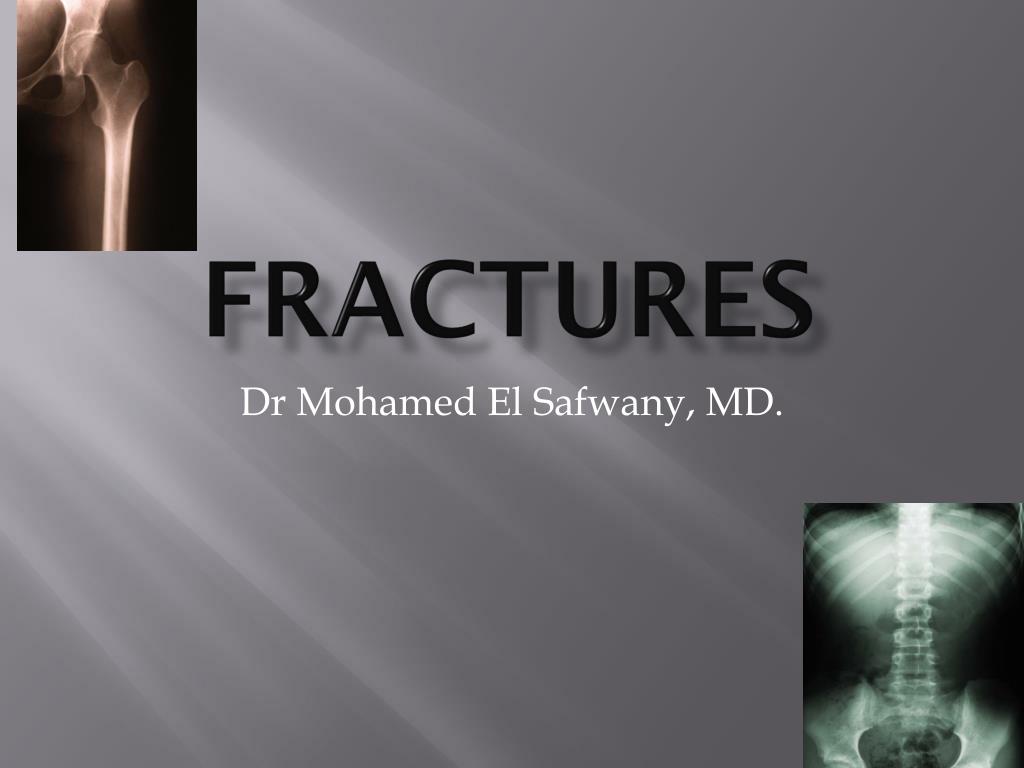 PPT - Fractures PowerPoint Presentation, free download - ID:2619015