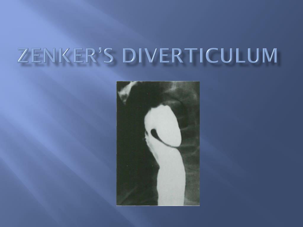 PPT - Zenker’s Diverticulum PowerPoint Presentation, free download - ID ...