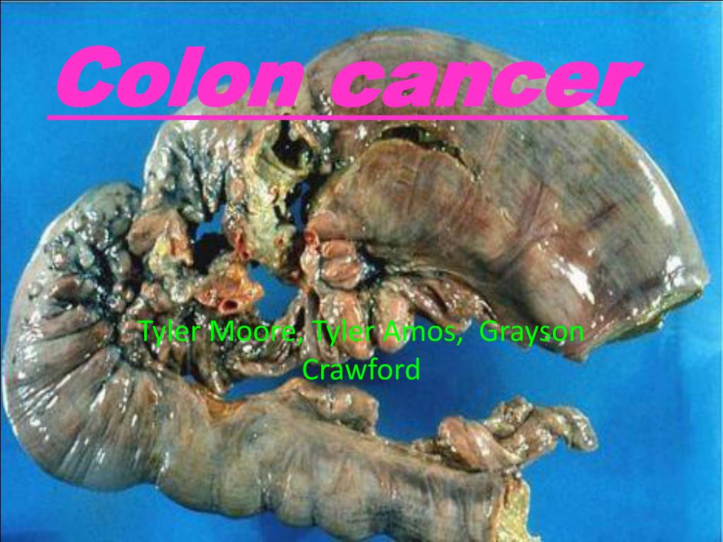 PPT - Colon cancer PowerPoint Presentation, free download - ID:2633477