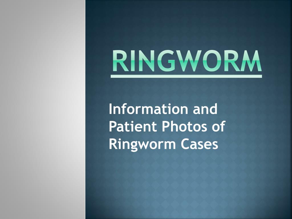 PPT - Ringworm PowerPoint Presentation, free download - ID:2634085