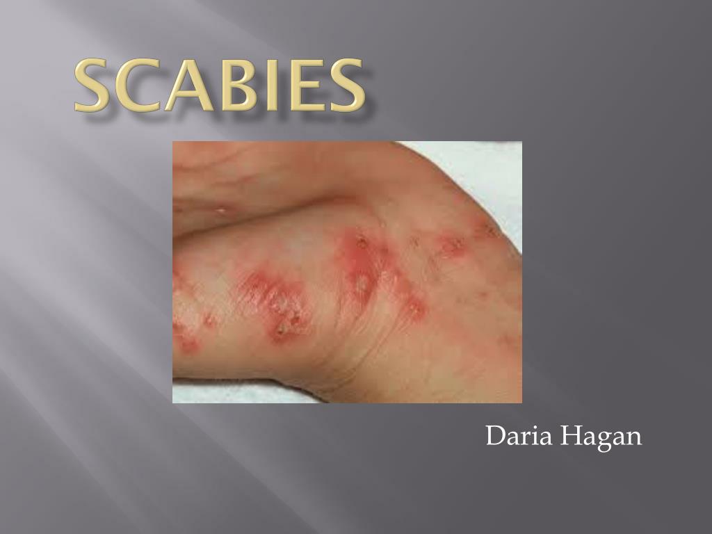 PPT - Scabies PowerPoint Presentation, free download - ID:2638237