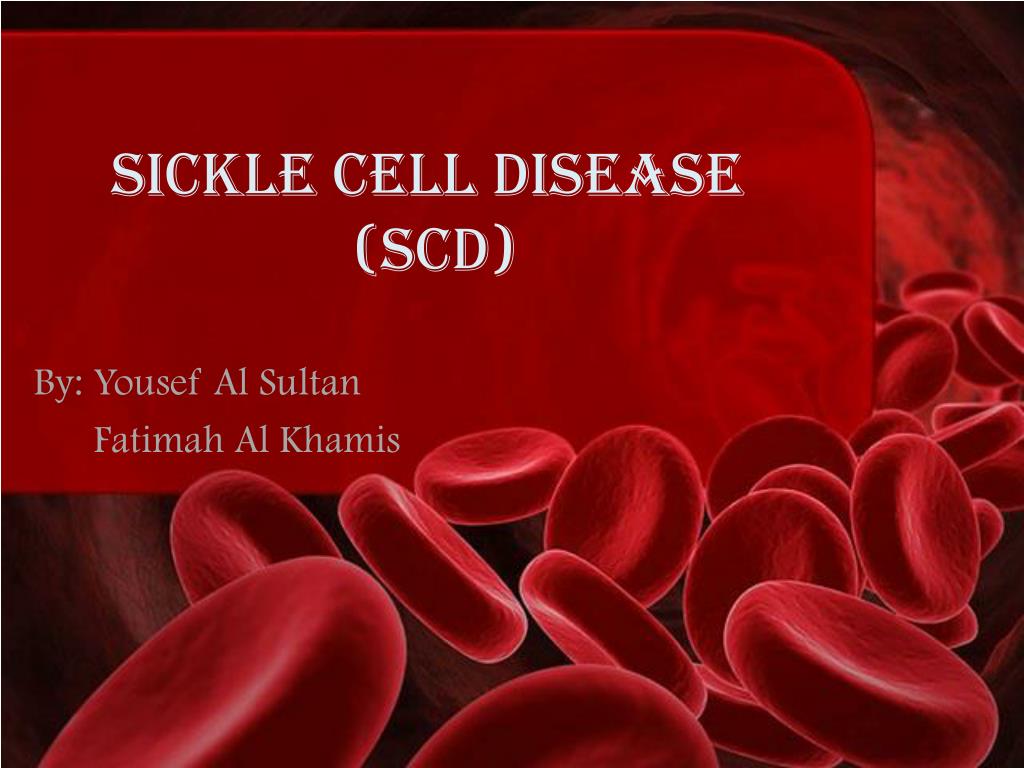 PPT - SICKLE CELL DISEASE ( scd ) PowerPoint Presentation, free ...