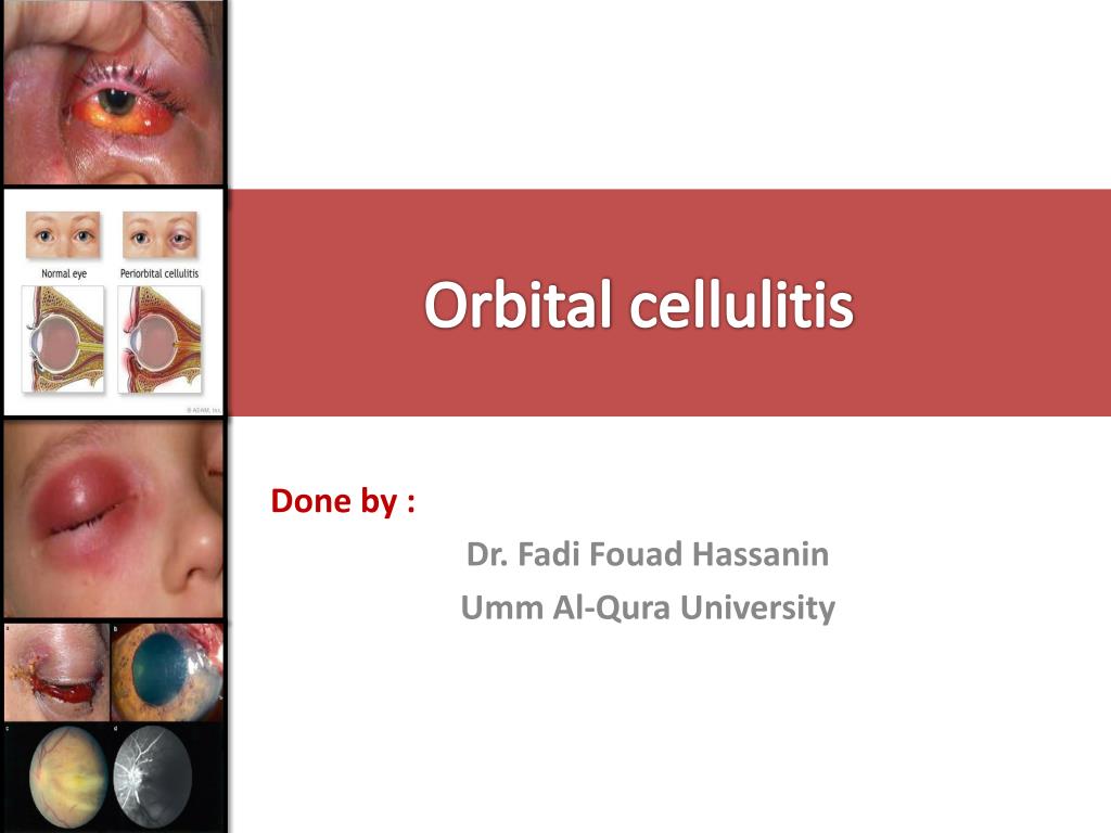 PPT - Orbital cellulitis PowerPoint Presentation, free download - ID ...