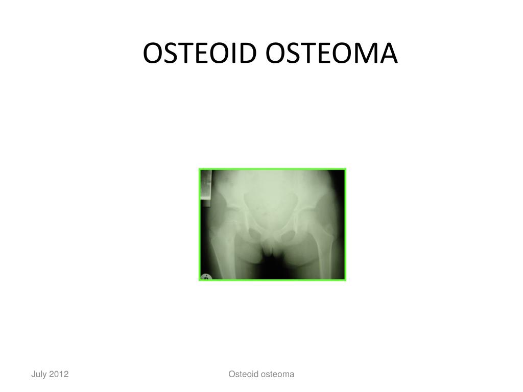 PPT - OSTEOID OSTEOMA PowerPoint Presentation, free download - ID:2702741