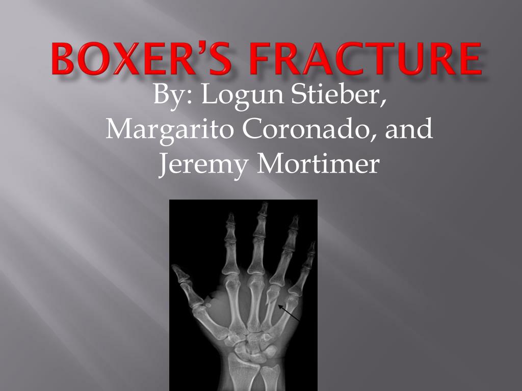 PPT - Boxer’s Fracture PowerPoint Presentation, free download - ID:2719970