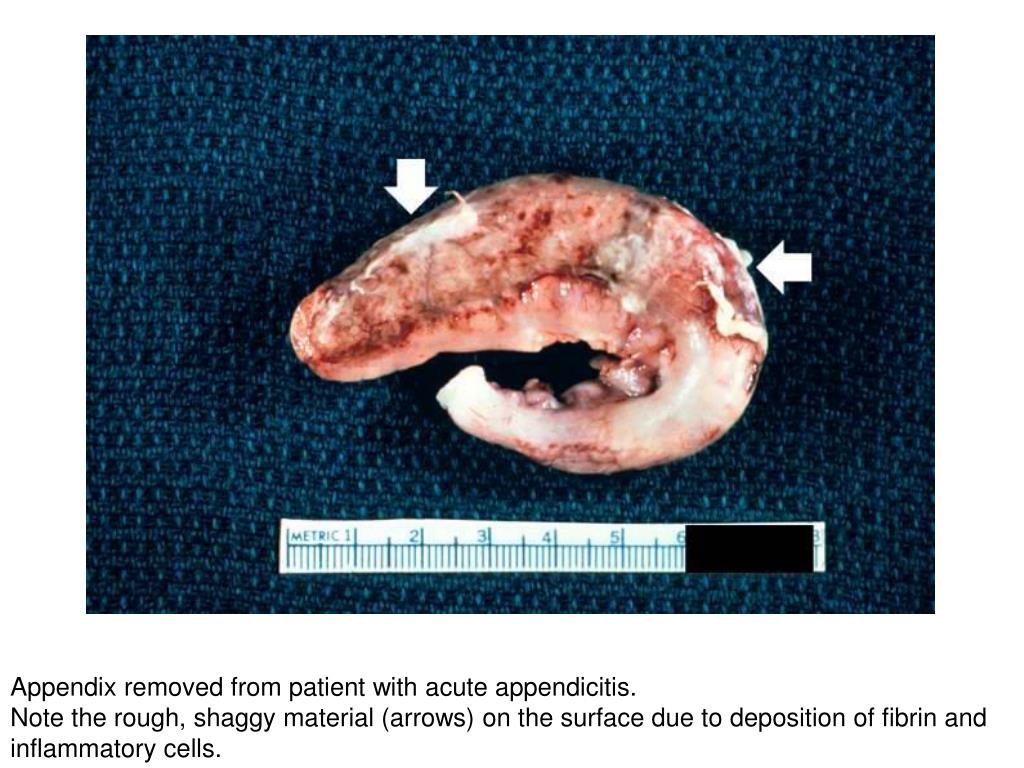PPT - Appendix removed from patient with acute appendicitis. PowerPoint ...