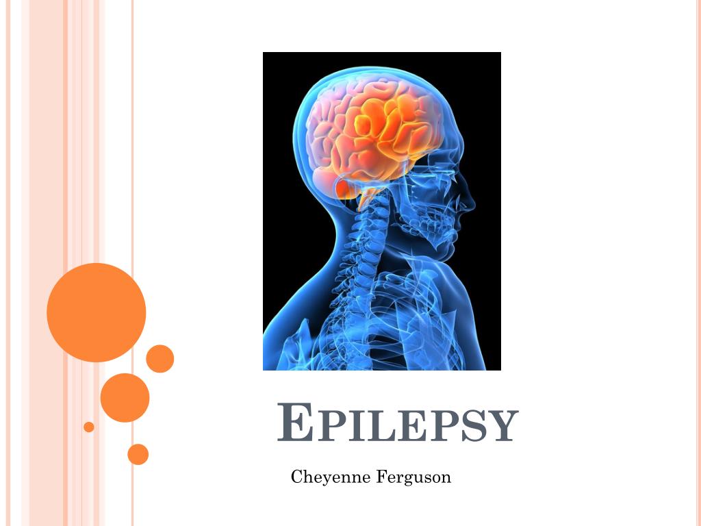 PPT - Epilepsy PowerPoint Presentation, free download - ID:2797645