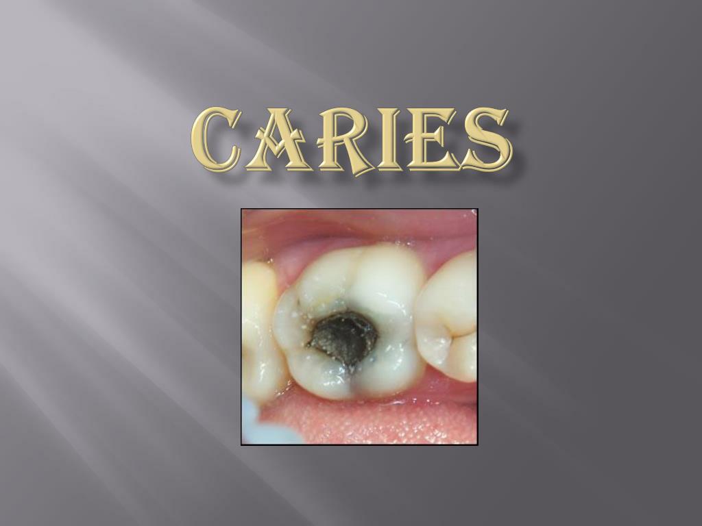 PPT - CARIES PowerPoint Presentation, free download - ID:2842719