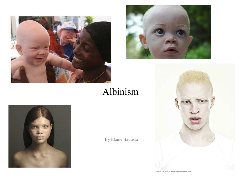 PPT - Albinism PowerPoint Presentation, free download - ID:2875377